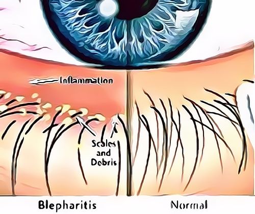 Obat Blefaritis Resep Herbal HNI HPAI - Bisnis HNI Online